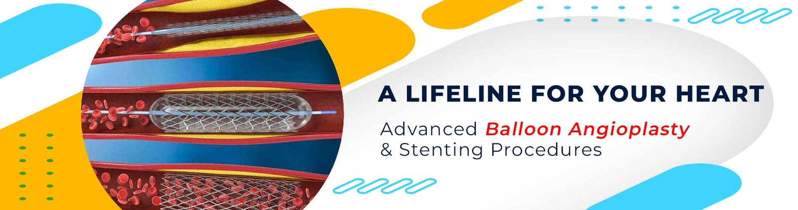 Balloon Angioplasty with Stent Implantation - DR. Siddharth Dagli